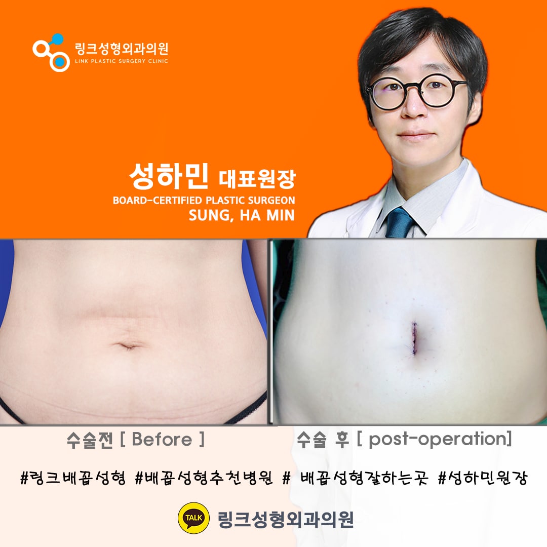 korean plastic surgery | link plastic surgery | BELLY BUTTON RESHAPING ...